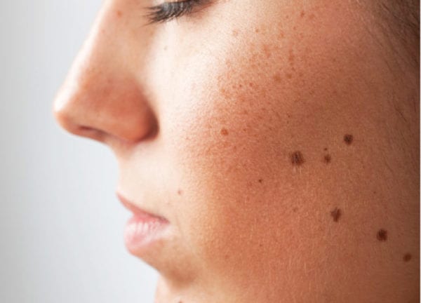 Skin Growths - Aestheticaskin Health and Wellness Center